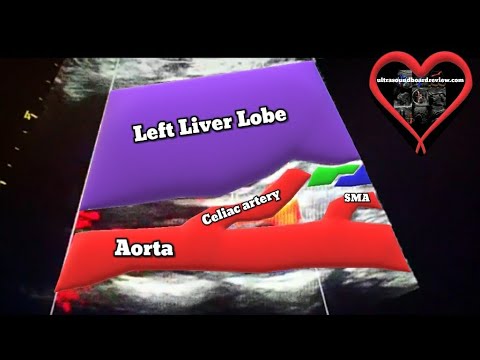 Celiac Artery Compression Syndrome Ultrasound - YouTube