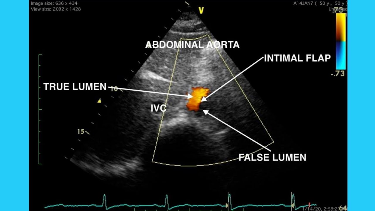 Aortic Dissection Echocardiography - YouTube