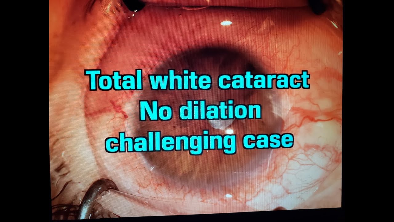 Total dense White cataract, no dialation. Would you make this surgery ...