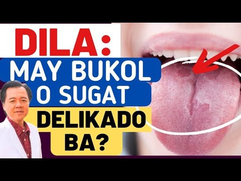 Dila May Bukol o Sugat: Delikado Ba? Alamin ang Senyales ng Oral Can ...