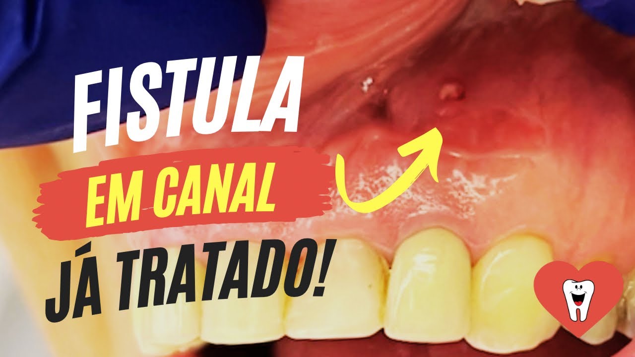 É ASSIM QUE SE RESOLVE UMA FÍSTULA EM UM CANAL JÁ TRATADO - Endolovers ...