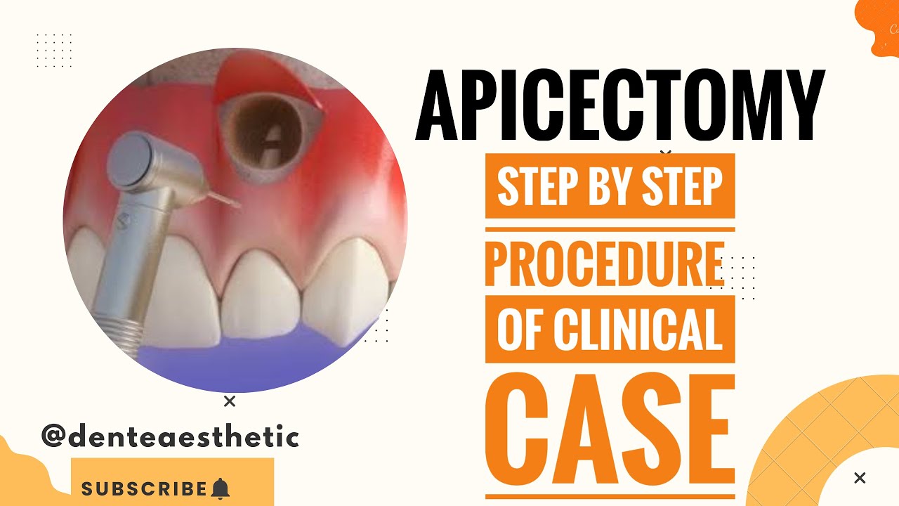 Apicectomy procedure| step by step |#dentistry #viralvideo #clinical # ...