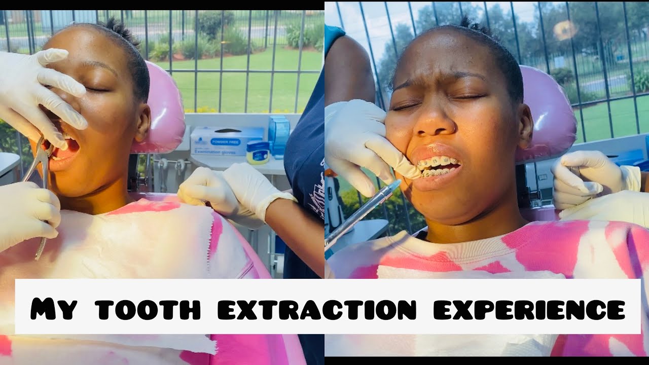 VLOG: Tooth Extraction For Braces| South African YouTuber - YouTube