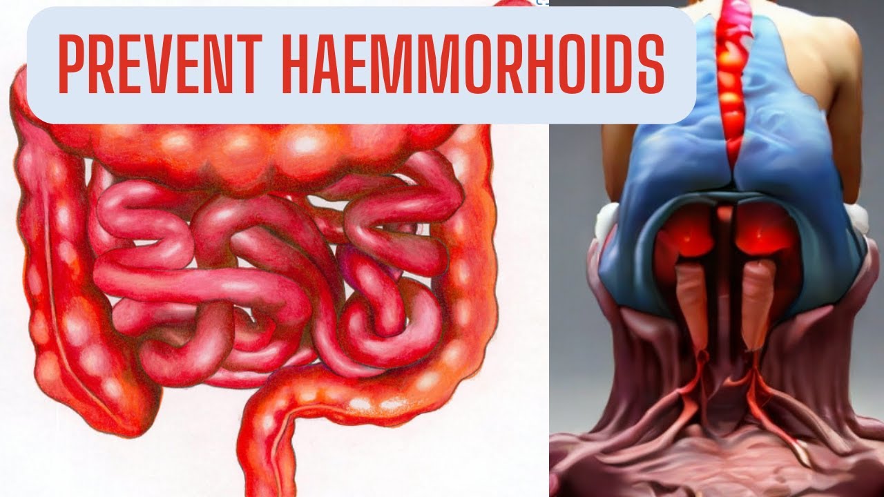 Behind the Pain: Understanding and Preventing Haemorrhoids. - YouTube