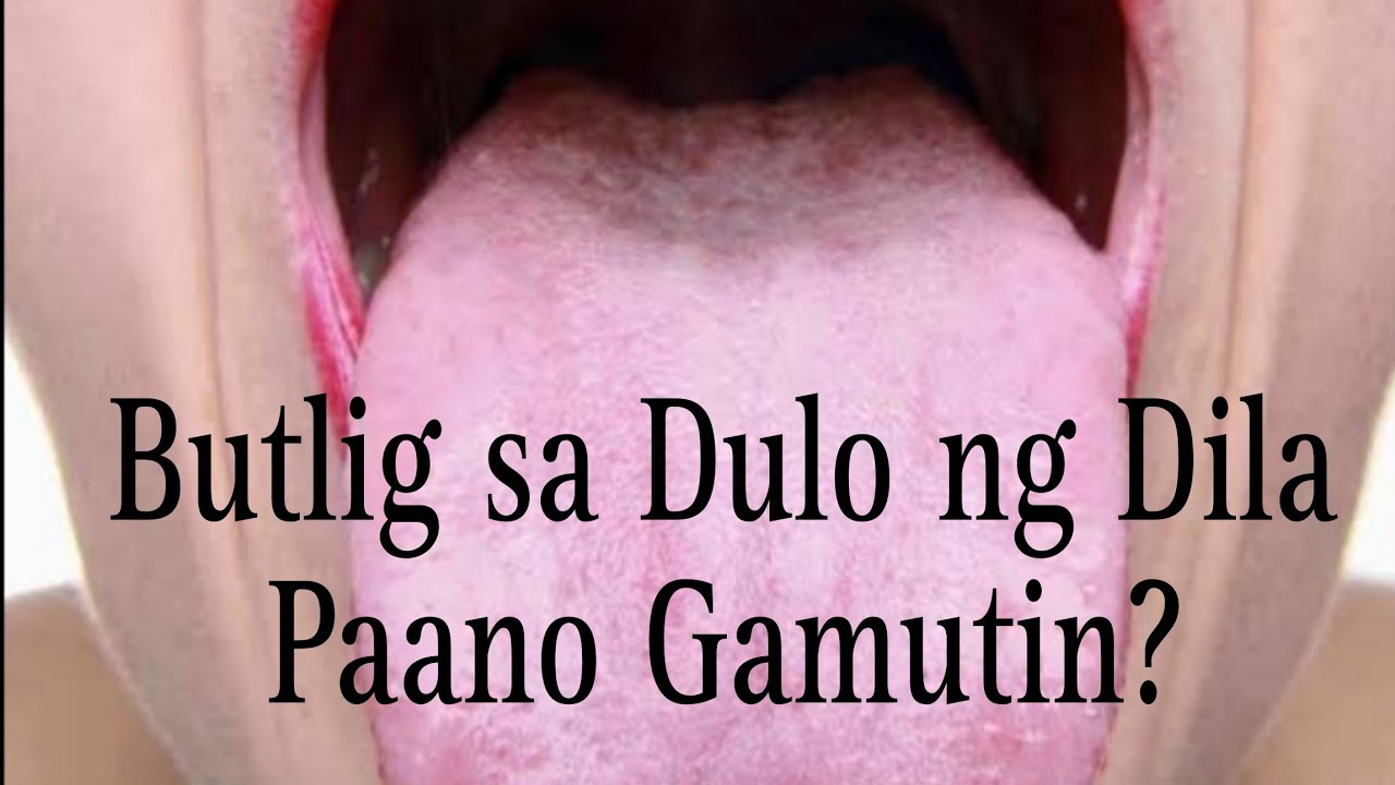 Butlig sa Dulo ng Dila Paano Gamutin? | Home Remedies | Mhon Montenegro ...