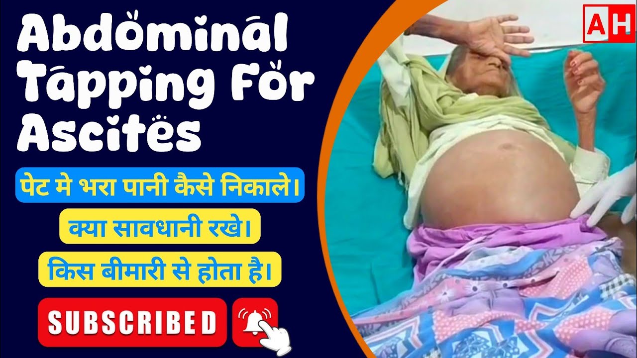 Ascitic Fluid Tapping Technique. Ascitic Tap Procedure, Peritoneal ...