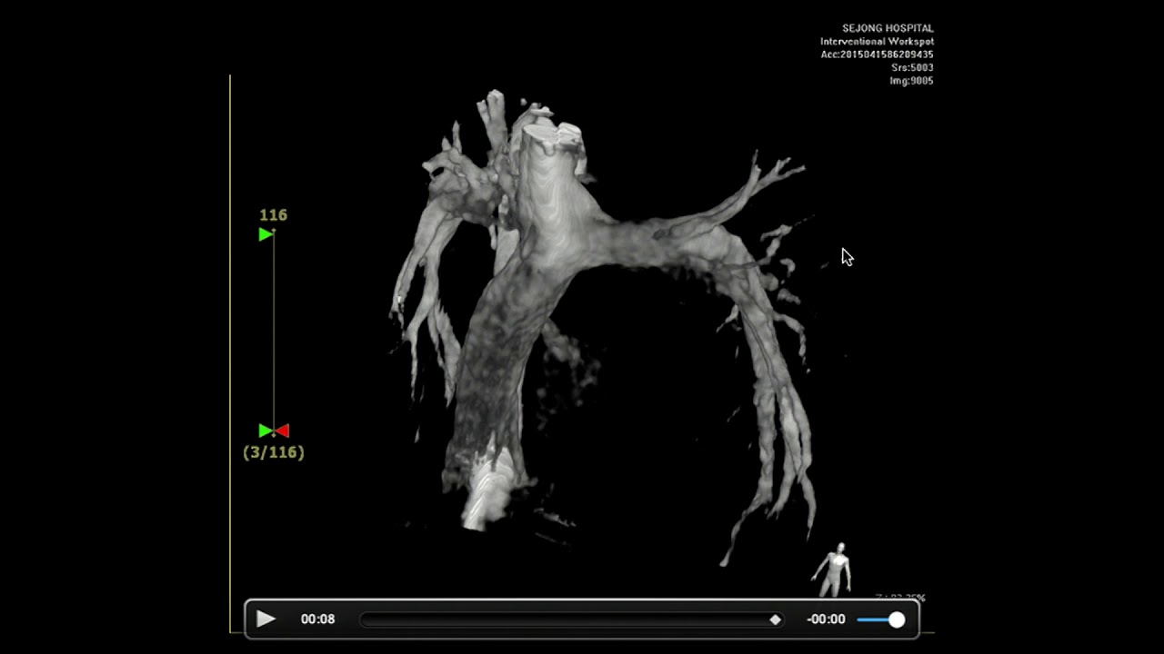 Echonavigator, vessel navigator & 3D rotational angiography - YouTube