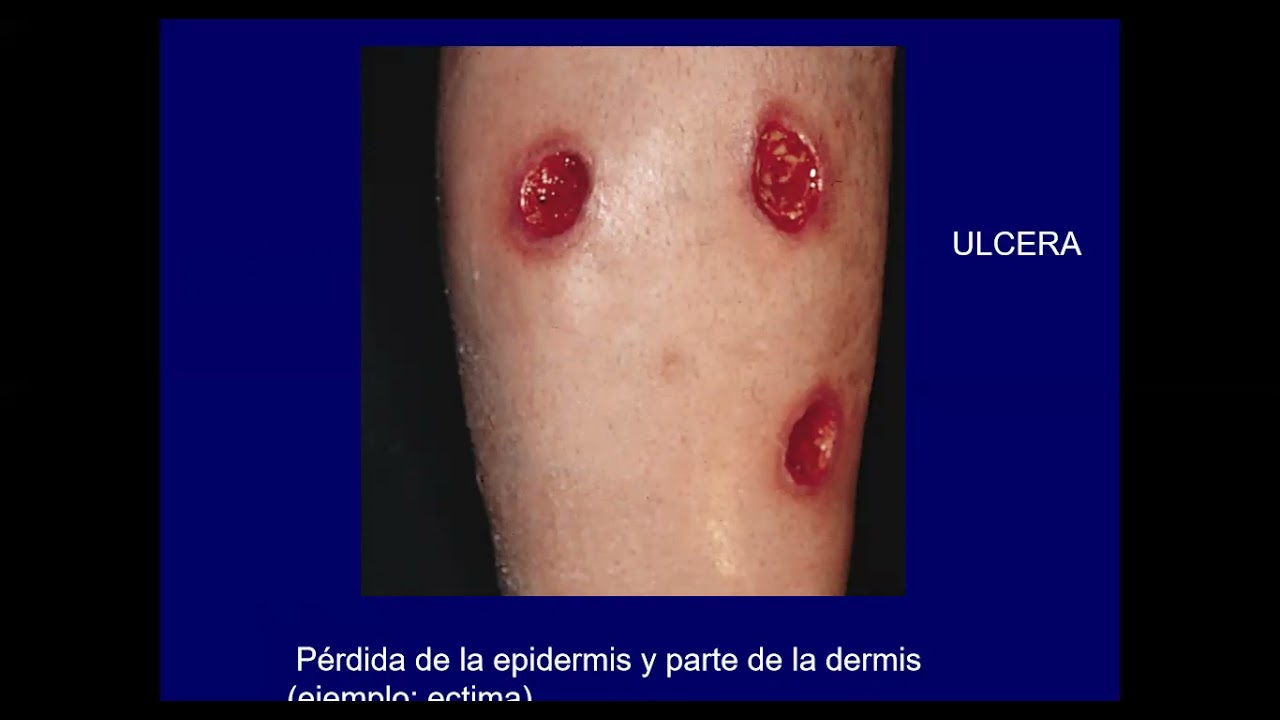 Patología no neoplasica de piel - YouTube