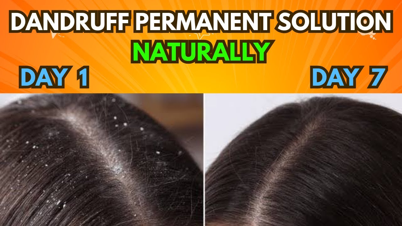 How to Treat Dandruff at Home | How to treat dandruff and Itchy Scalp ...