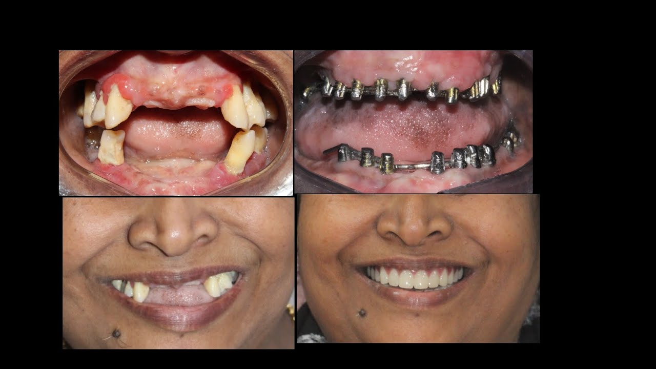 Beautiful Smile Makeover in 5 days with Full Mouth Dental Implant in ...