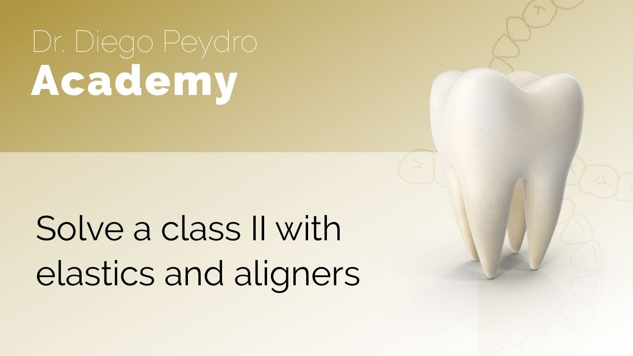 Solve a Class II with elastics and aligners - YouTube