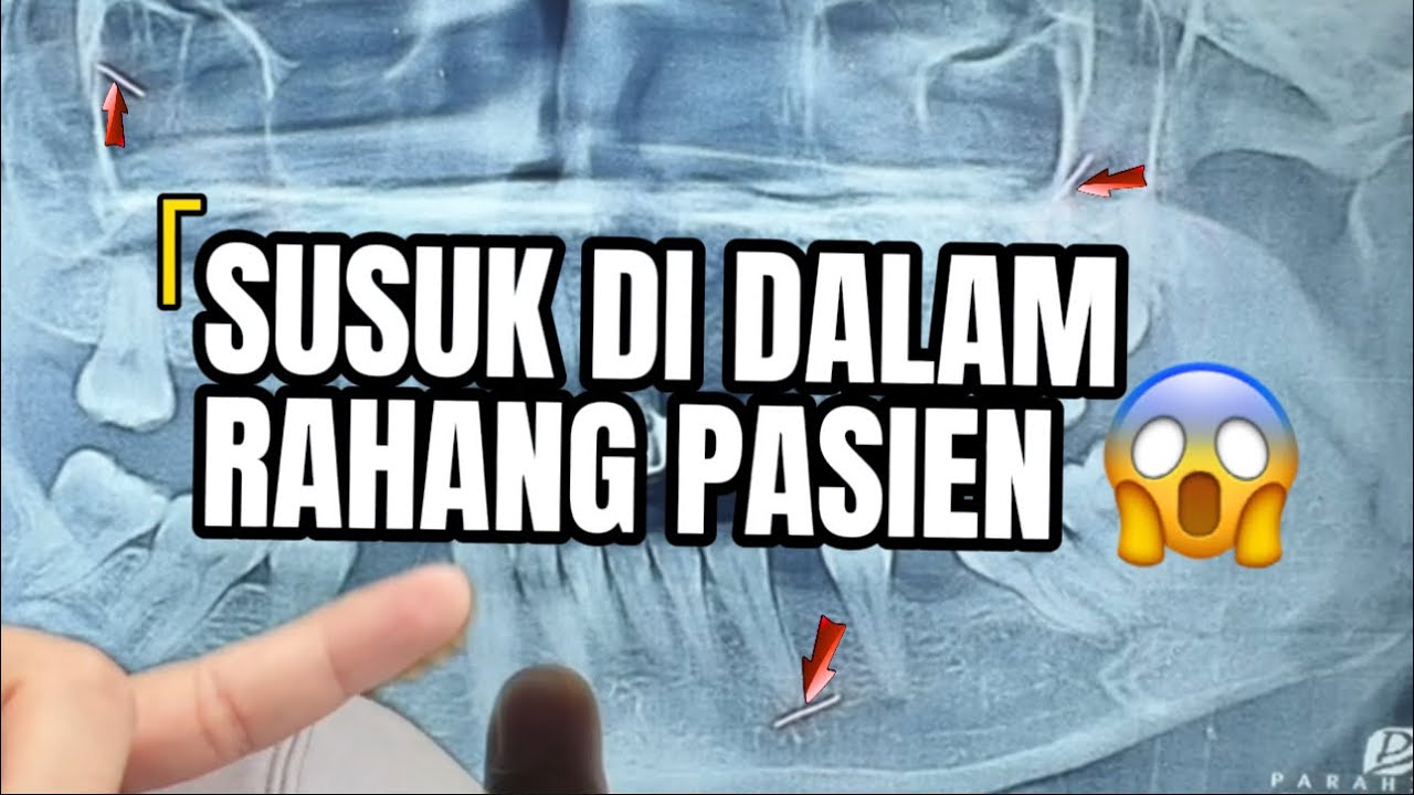 Susuk itu adalah benda nyata jadi tetap bisa terlihat dari rontgen foto ...