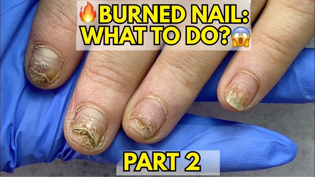 What’s Up With My Nails? 😱😫 Part 2 – Dealing with Nail Lifting ...