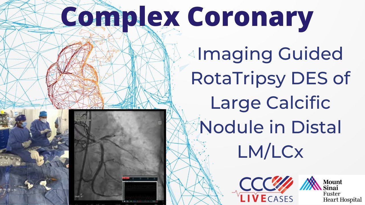 Imaging Guided RotaTripsy DES of Large Calcific Nodule in Distal LM/LCx ...