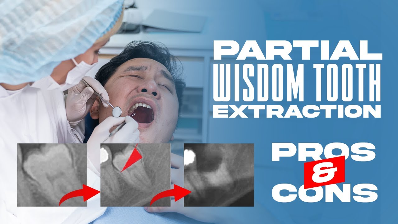 "Partial Wisdom Tooth Extraction: Pros & Cons" - YouTube