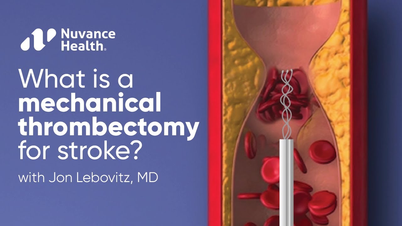 What is a Mechanical Thrombectomy for Stroke? - YouTube