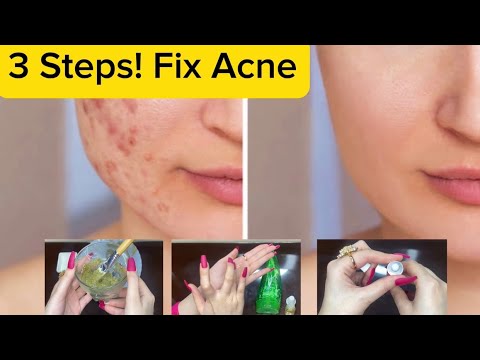 3 Steps To Fix Your Acne | No More Acne, Pimples Dark Spots + Get Fair ...