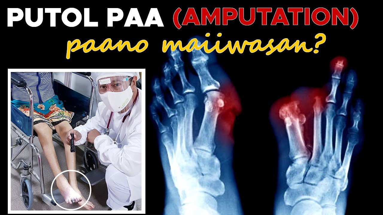 PUTOL PAA (AMPUTATION) paano maiiwasan? - YouTube