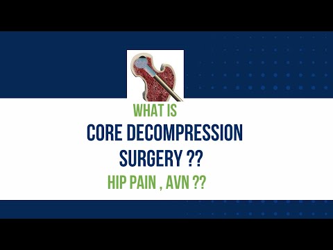 Core decompression surgery | AVN hip | #avn #covid19 #hippain # ...