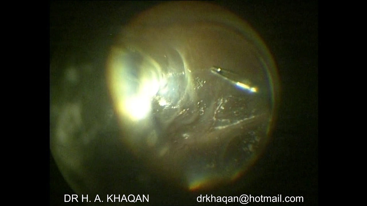 Vitrectomy for PVR by Dr Hussain Ahmad Khaqan Video 1 - YouTube