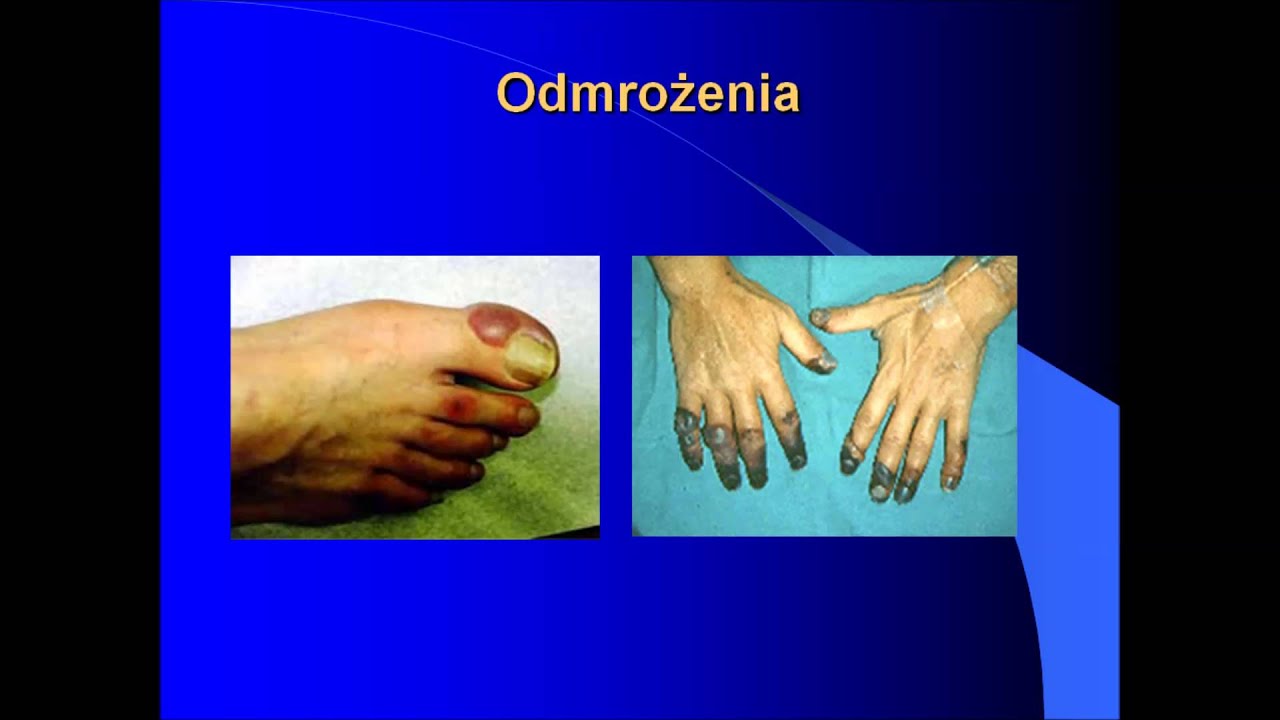 Prezentacja multimedialna - Odmrożenia - Pierwsza Pomoc bez tajemnic ...