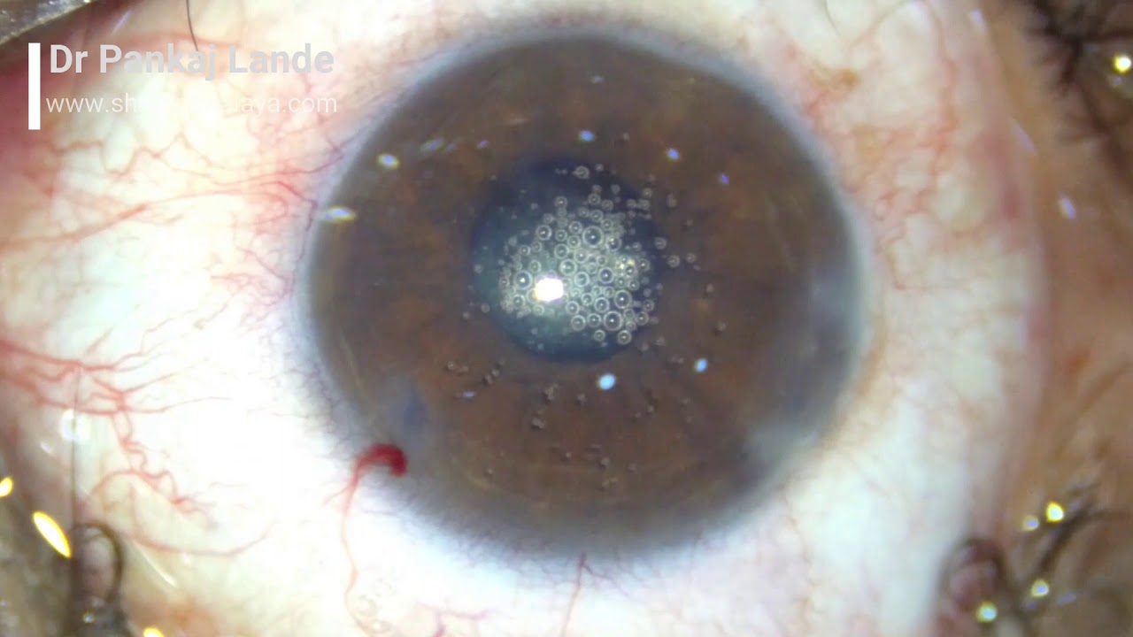 Triple ,phaco with IOL with DSEK - YouTube