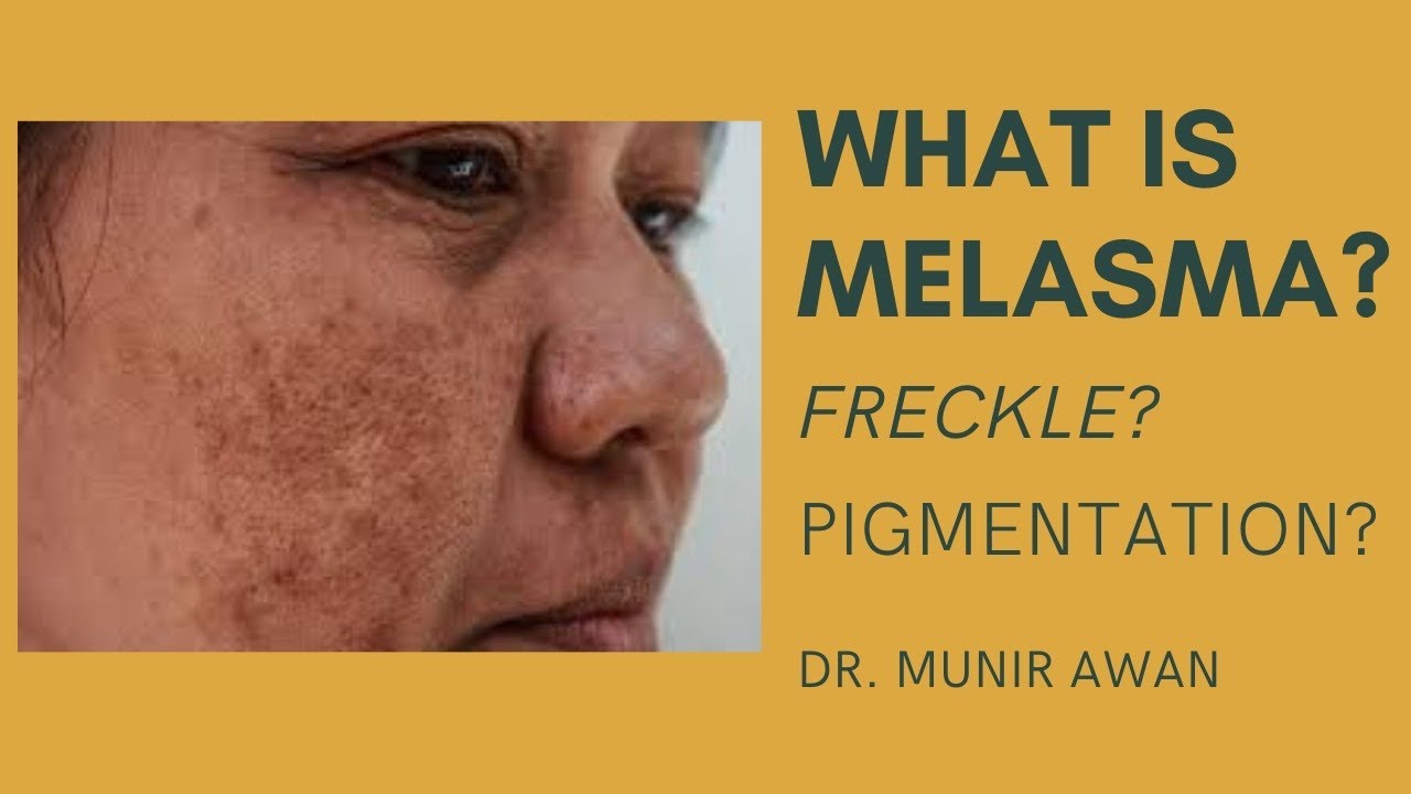 How to treat Melasma - YouTube