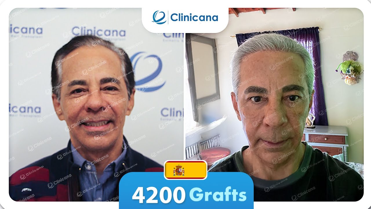 Mr. Bedoya Shares His 6 Months Hair Transplant Operation Result in ...