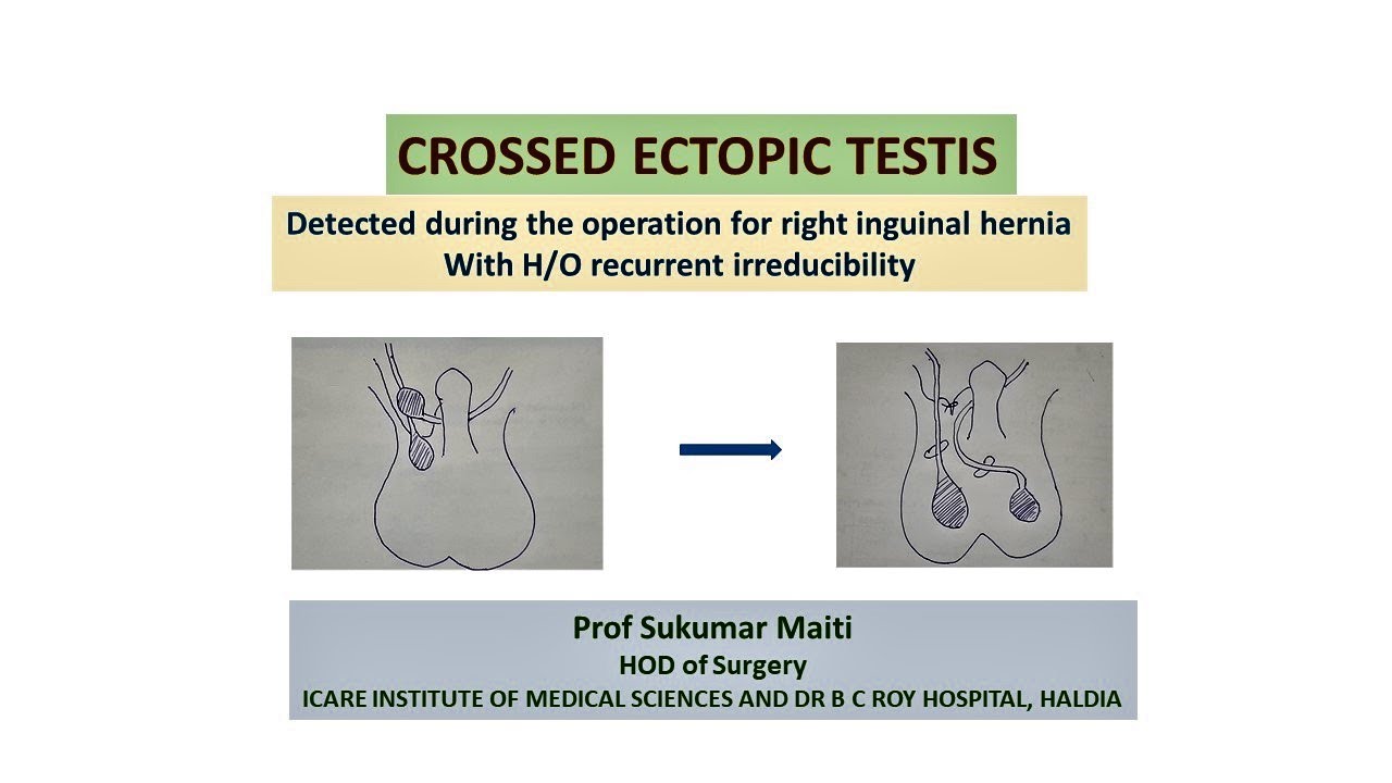 CROSSED ECTOPIC TESTIS- diagnosed during operation for inguinal hernia ...