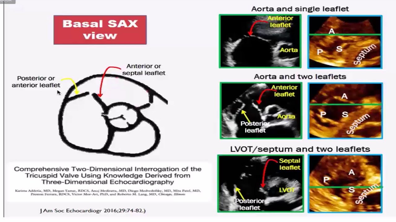 Tricuspid Valve Anatomy Echo Frontiers | Tricuspid Regurgitation In