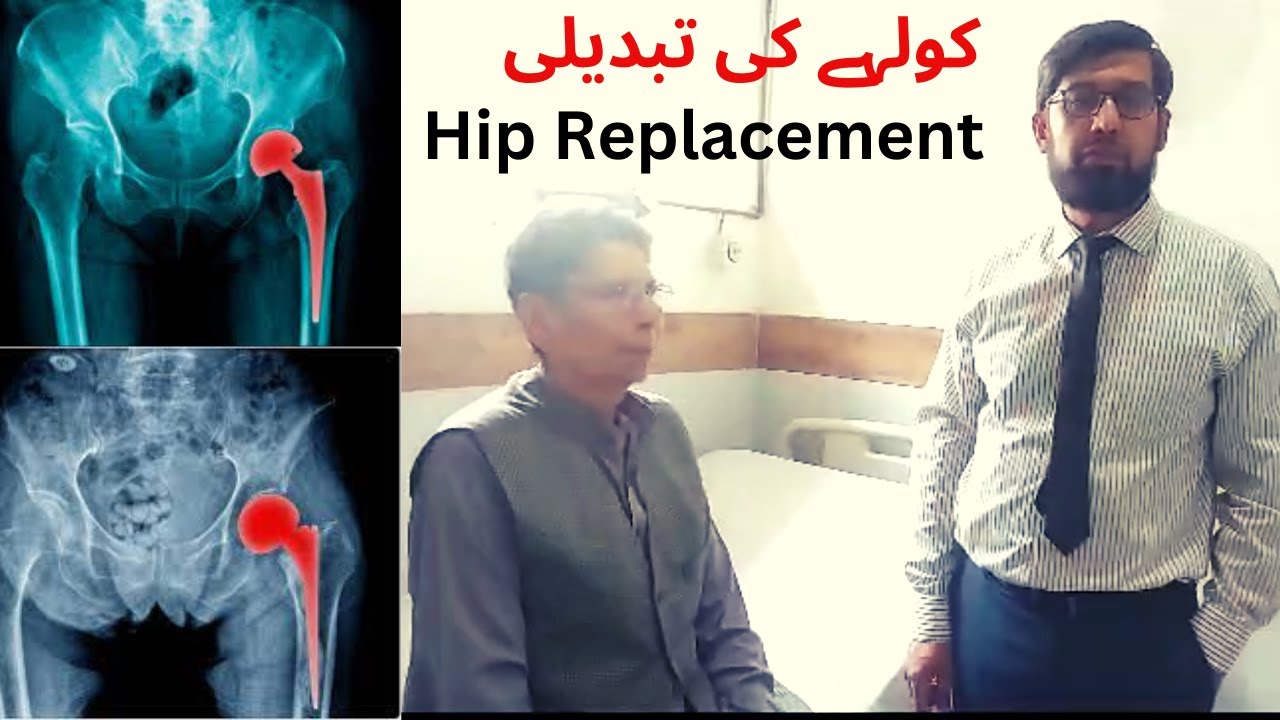 Complex Total Hip Replacement With Cage Fixation After Fracture ...