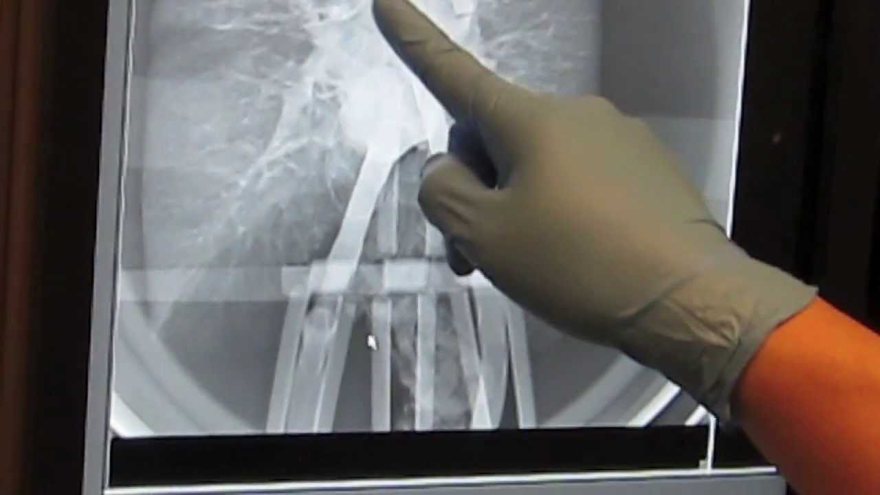 Toronto Ex Vivo Lung Perfusion System - YouTube