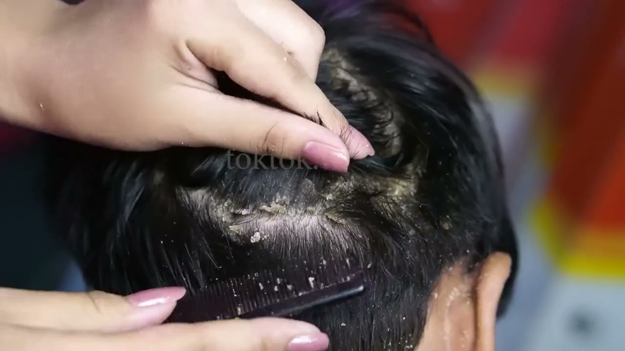 Dandruff Scratching Asmr 2 Youtube