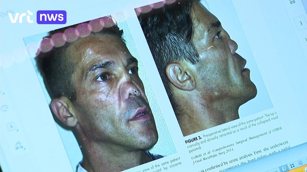 Meer neusoperaties door cocainegebruik - YouTube