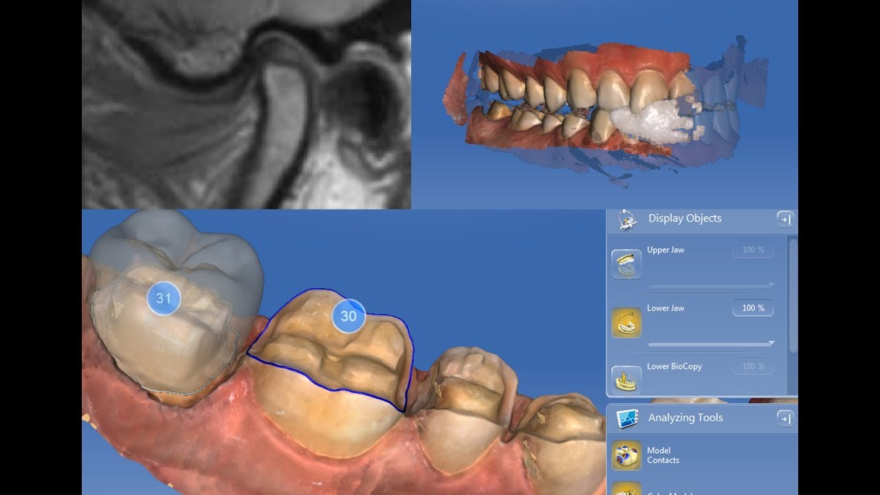 TMD Treated Via MRI Scan-Based Mandibular Repositioning - YouTube