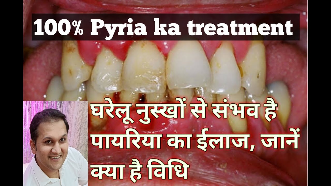 पायरिया से परेशान हैं तो अपनाएं ये घरेलू नुस्खे || Pyria || Pyorrhea ...