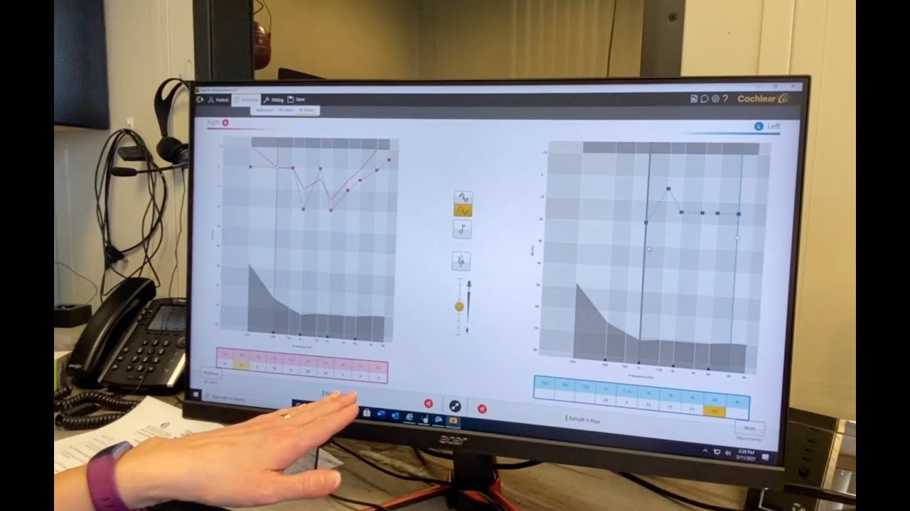 Programming new Cochlear Baha 6 Max! - YouTube
