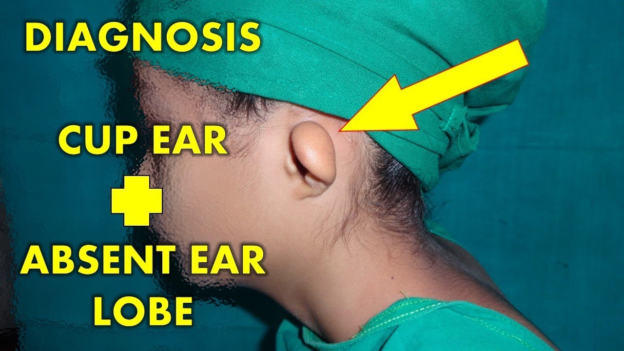 DIAGNOSIS - CUP EAR + ABSENT EAR LOBE |DR.M.BHANU MURTHY | PLASTIC ...