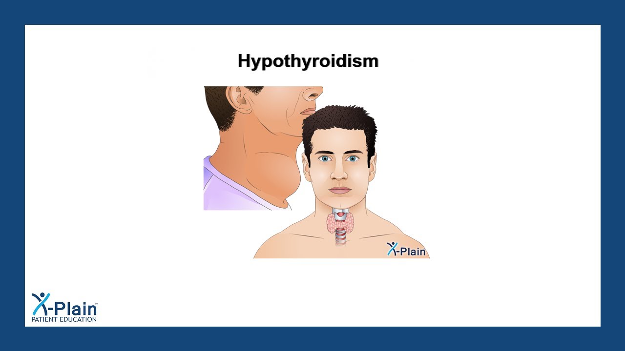 Hypothyroidism (patient education) - YouTube