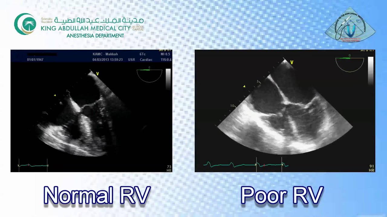 047 RV function & Pulmonary Embolism TEE KAMC - YouTube