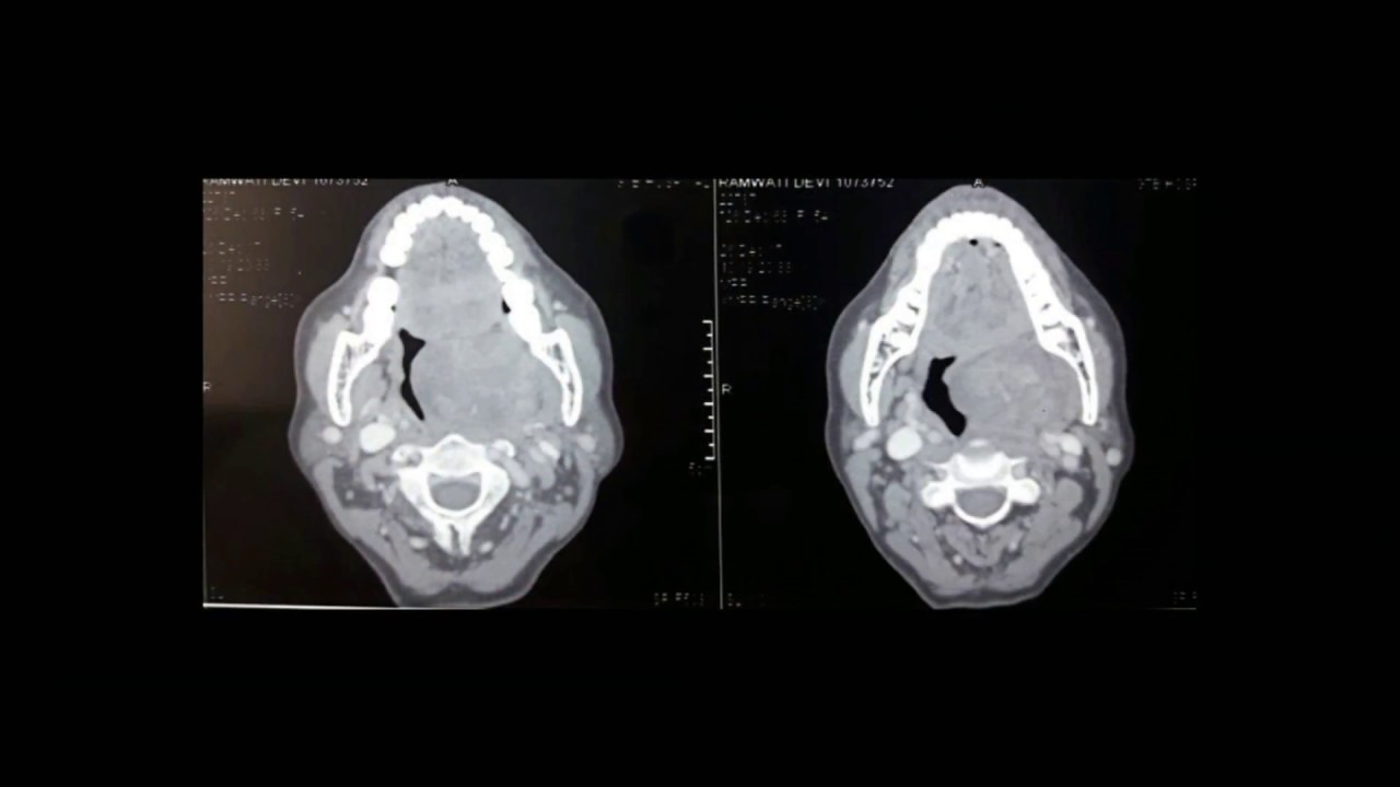 Parapharyngeal space approaches : mandibular swing - YouTube