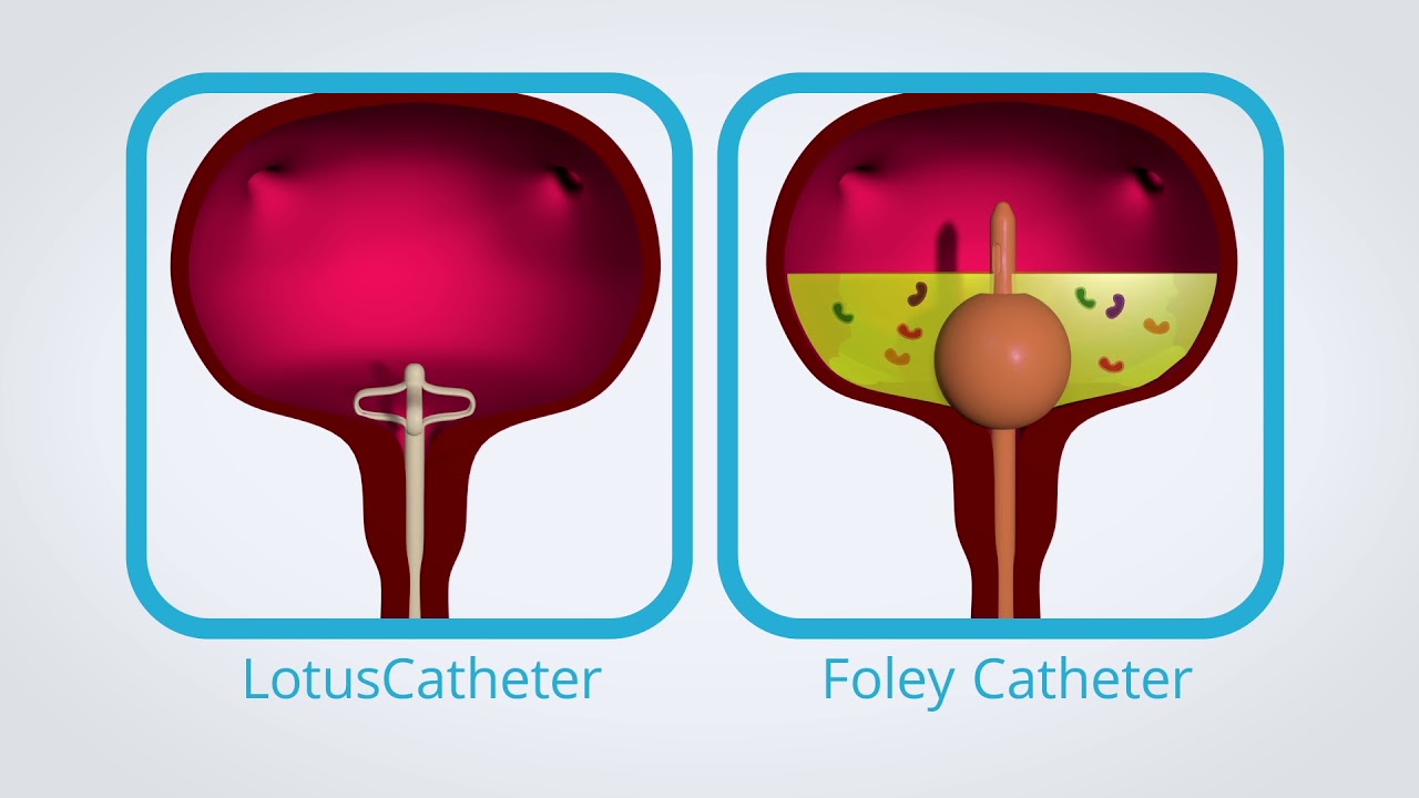 Lotus Catheter Introduction - YouTube
