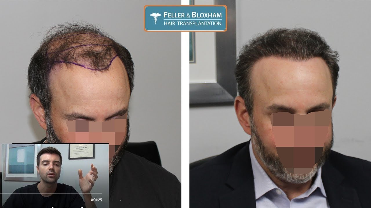 12 Month "Hair Plugs" Repair Result: How We Did It | Feller & Bloxham ...