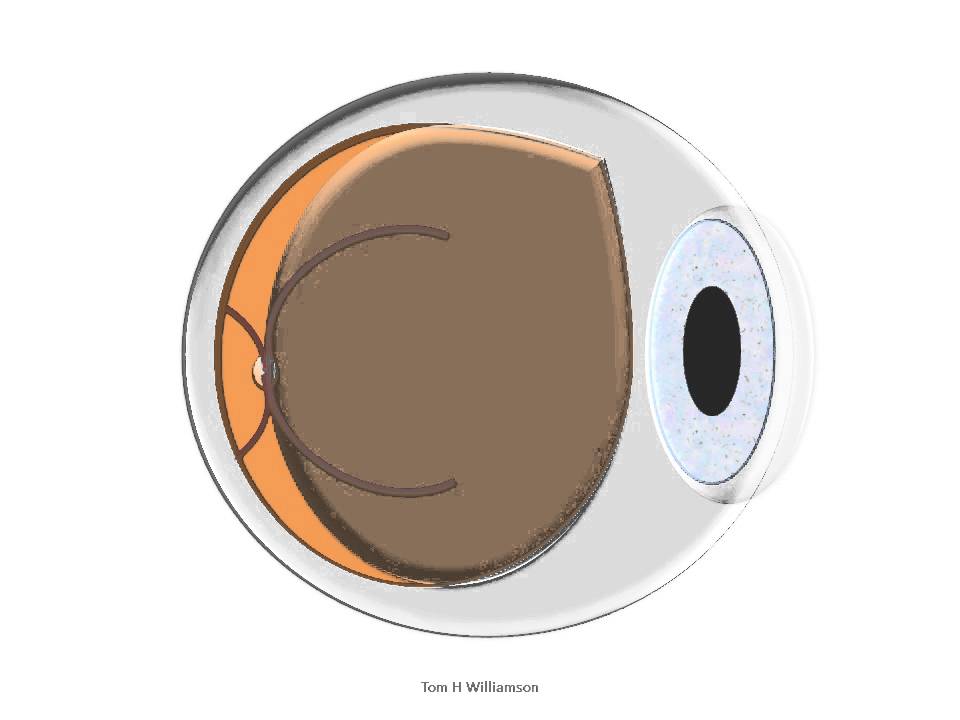 Posterior vitreous detachment - YouTube