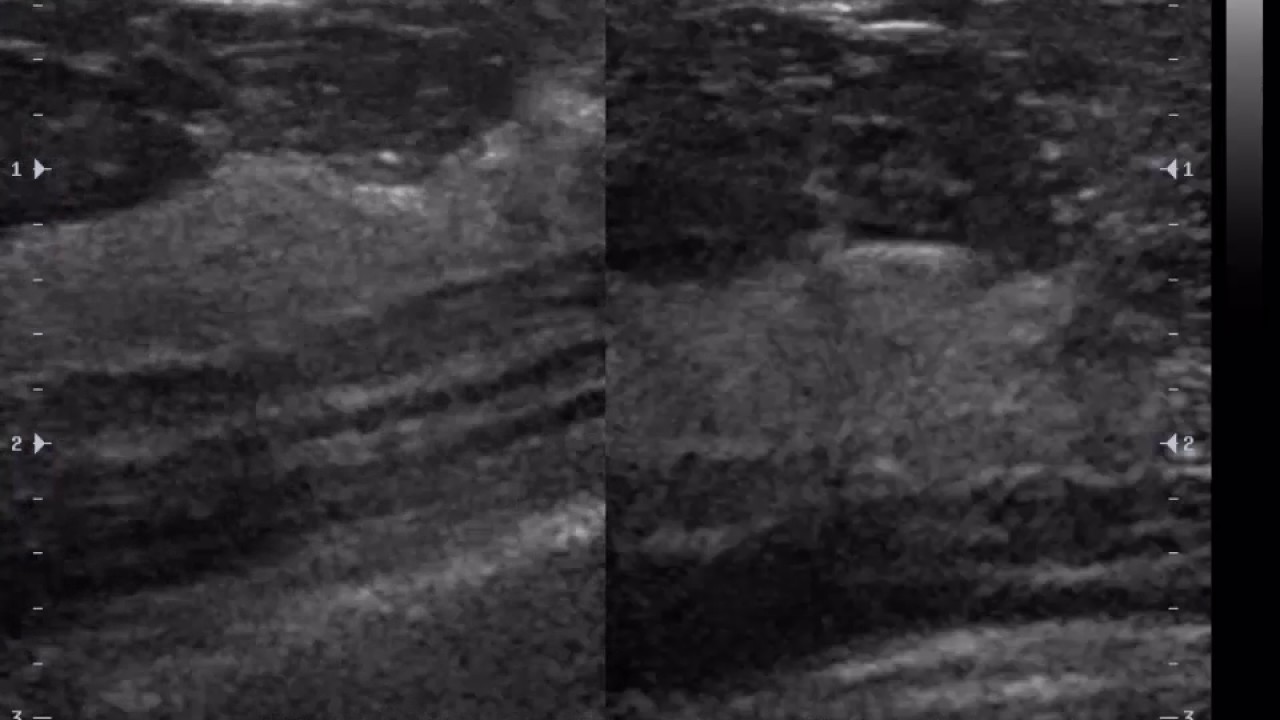 CASE 272 sonomammography left breast upper periareolar partially ...