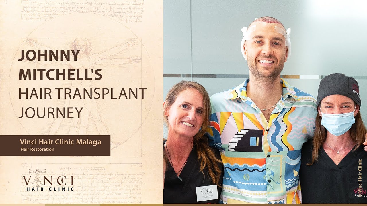 Johnny Mitchell's Hair Transplant Journey at Vinci Hair Clinic in ...