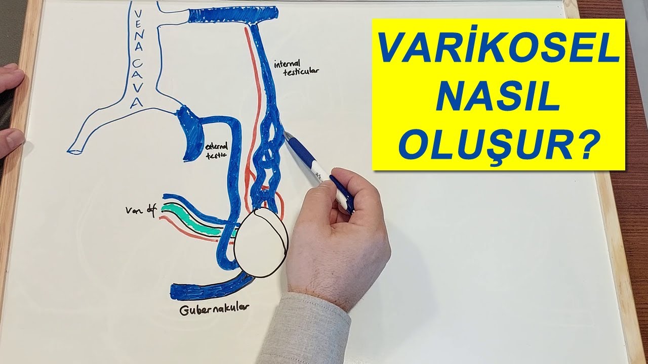 Varikosel Nasıl Oluşur? Nüks Varikoseli Nasıl Tedavi Ediyoruz? 20 Yılı ...