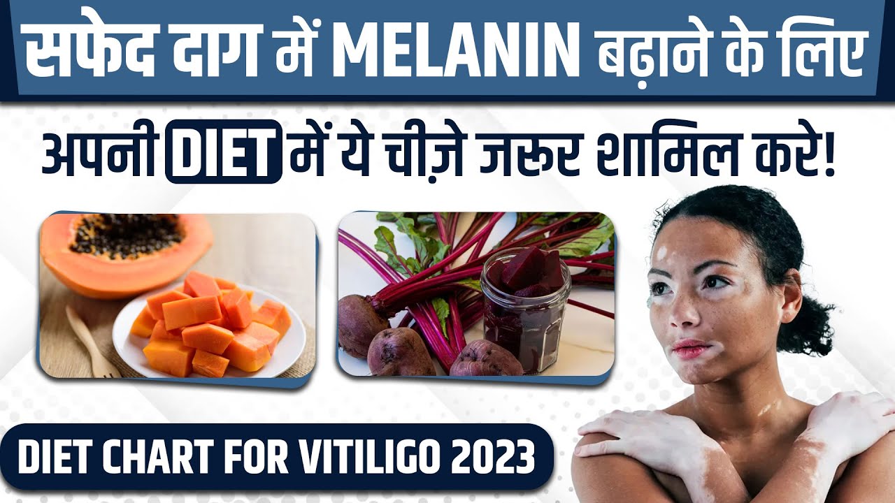 Safed Daag के रोगियों को क्या खाना चाहिए? | Vitiligo Diet Chart | Safed ...