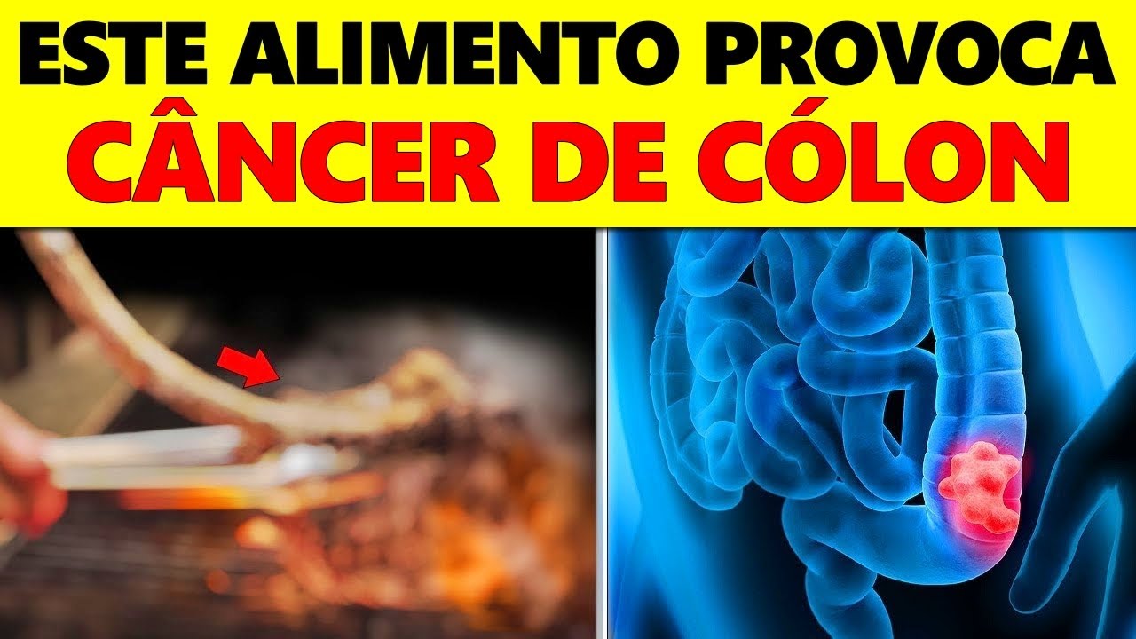 É Isso Que Causa CÂNCER De Cólon e Reto - Câncer Colorretal - YouTube