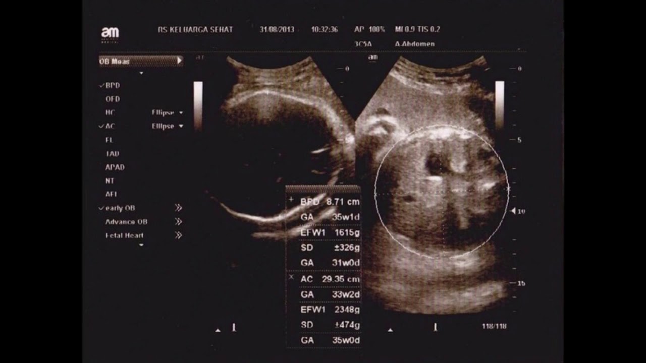 CARA MEMBACA HASIL USG DENGAN MUDAH - YouTube